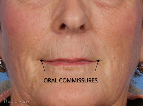 Lip Enhancement for Most Beautiful Lips Rejuvent Scottsdale