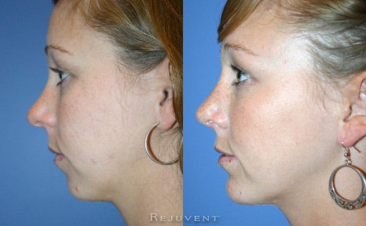 Is surgical chin augmentation for you? • Rejuvent Scottsdale