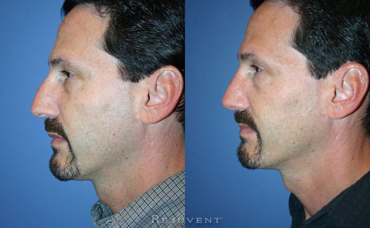 Rhinoplasty Photos at Rejuvent Scottsdale • Rejuvent Medical Spa Scottsdale