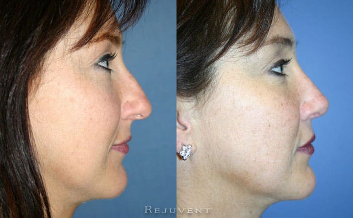 Rhinoplasty Photos at Rejuvent Scottsdale • Rejuvent Medical Spa Scottsdale