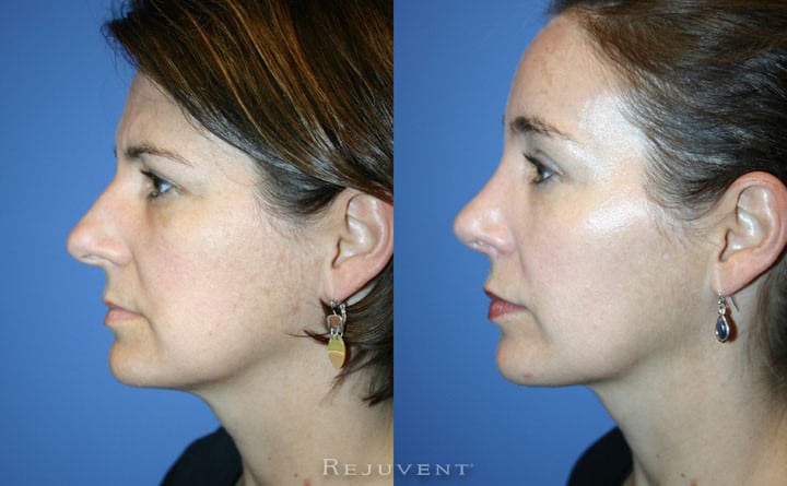 Rhinoplasty Photos at Rejuvent Scottsdale • Rejuvent Medical Spa Scottsdale