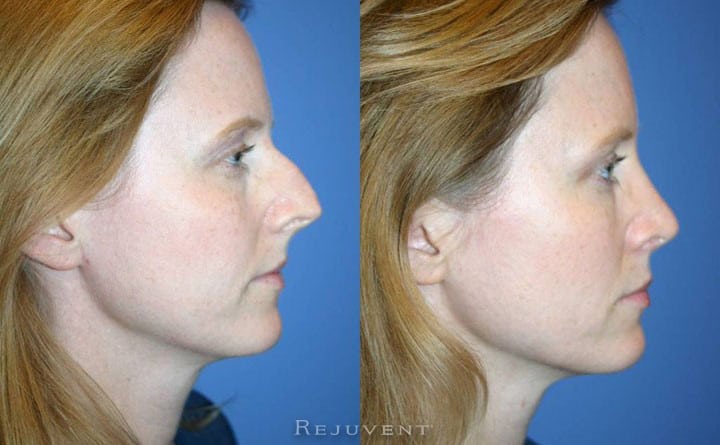 Rhinoplasty Photos at Rejuvent Scottsdale • Rejuvent Medical Spa Scottsdale