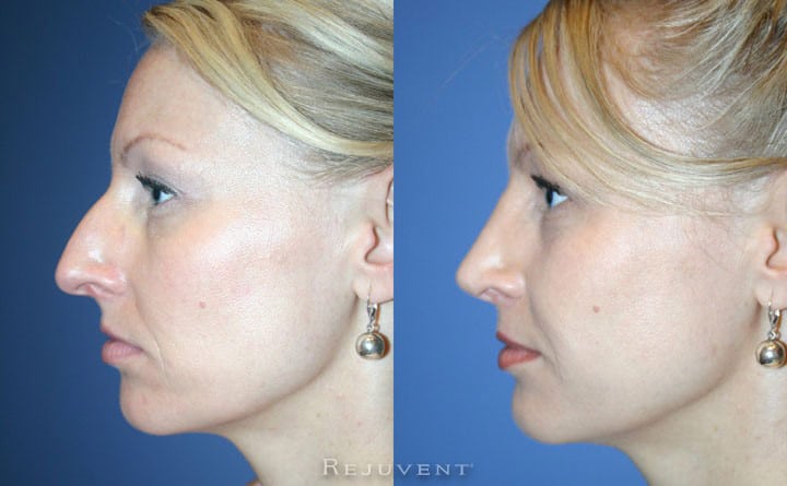 Rhinoplasty Results • Rejuvent Medical Spa Scottsdale