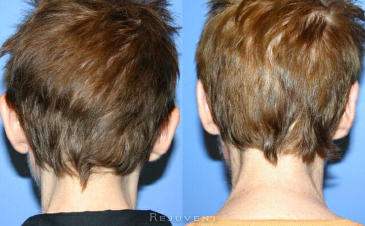 Otoplasty Photos Rejuvent Medical Spa Scottsdale