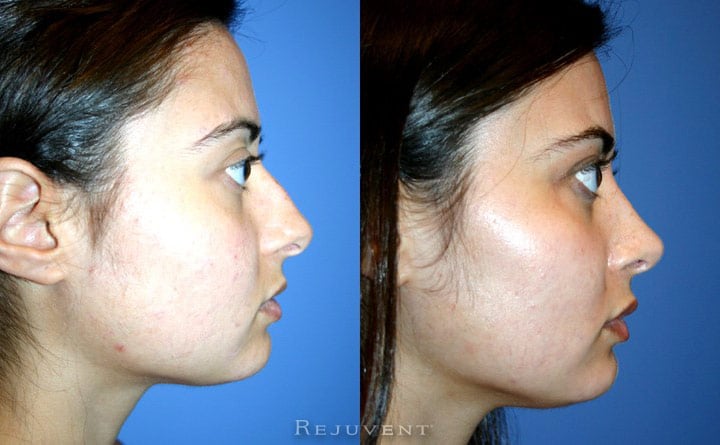 Rhinoplasty Photos at Rejuvent Scottsdale • Rejuvent Medical Spa Scottsdale
