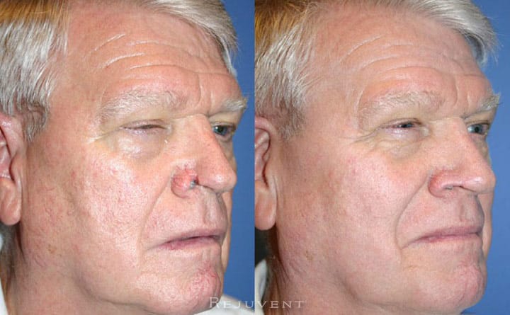 Rhinoplasty Photos at Rejuvent Scottsdale • Rejuvent Medical Spa Scottsdale