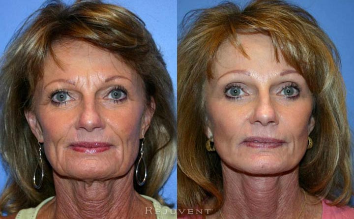 Looking Your Best in your 50s • Rejuvent Medical Spa Scottsdale