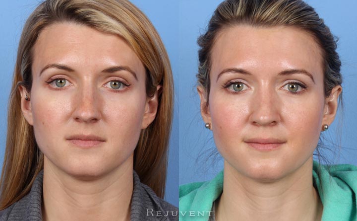 Rhinoplasty Photos at Rejuvent Scottsdale • Rejuvent Medical Spa Scottsdale