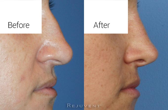Rhinoplasty Surgery Closeup Photos • Rejuvent Medical Spa Scottsdale