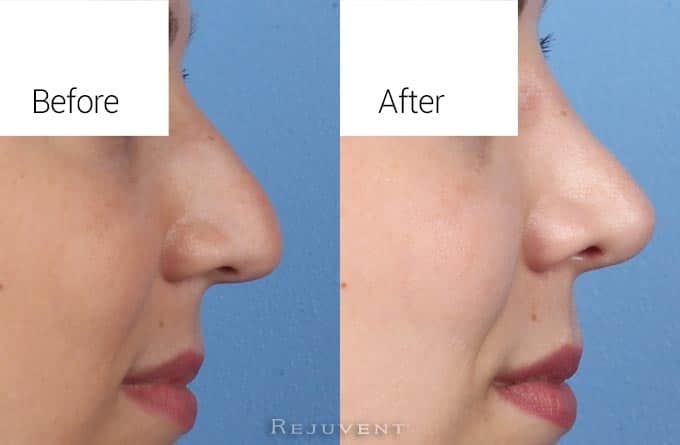 Rhinoplasty Photos at Rejuvent Scottsdale • Rejuvent Medical Spa Scottsdale