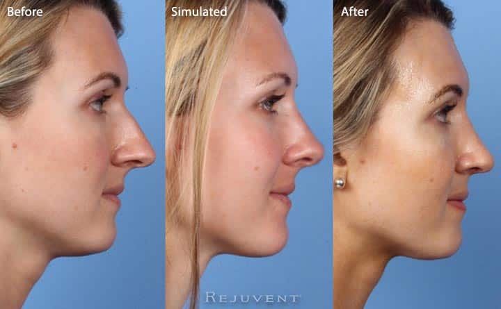 Rhinoplasty Photos at Rejuvent Scottsdale • Rejuvent Medical Spa Scottsdale