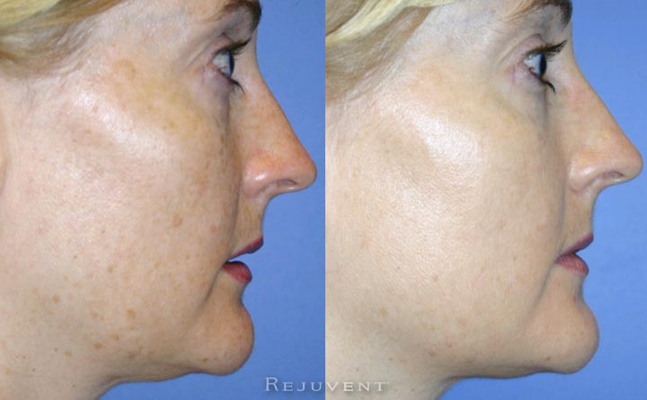 Aging Skin Photos • Rejuvent Medical Spa Scottsdale