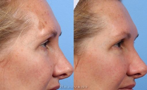 Lesion Excision • Rejuvent Medical Spa Scottsdale