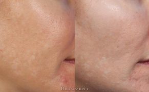 PRP Facial Treatment • Rejuvent Medical Spa Scottsdale