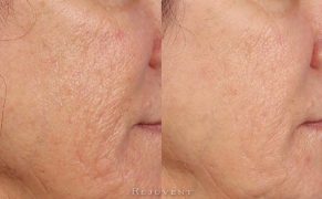 Fade Acne Scars eMatrix Fractional Resurfacing • Rejuvent Scottsdale