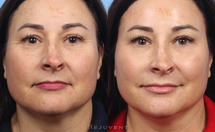 Liquid Facelift Photos Beautiful Results Rejuvent Scottsdale