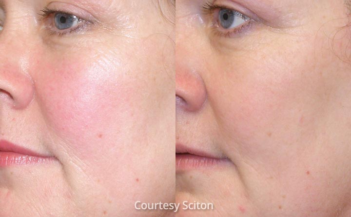 BBL Face in Scottsdale • Rejuvent Medical Spa Scottsdale