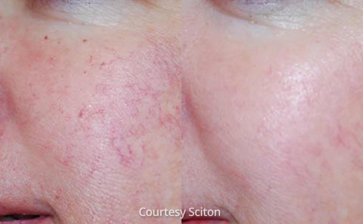BBL Face in Scottsdale • Rejuvent Medical Spa Scottsdale