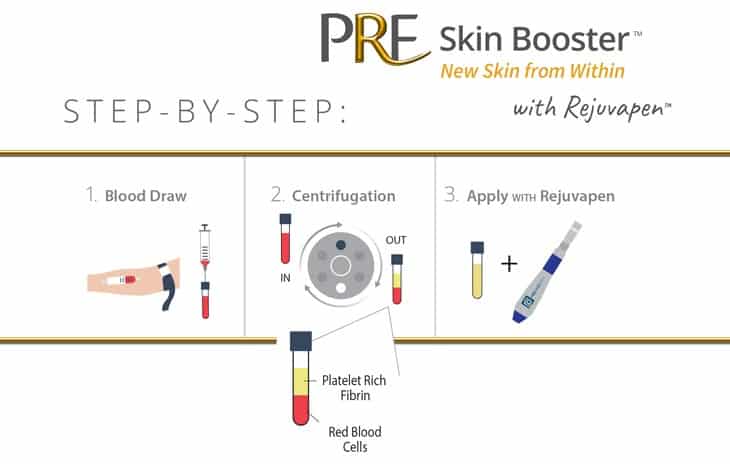 PRF with Microneedling • Rejuvent Medical Spa Scottsdale